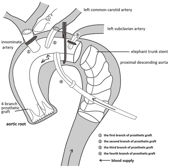 Myocardial Priority Promotes Cardiovascular Recovery for Acute Type A ...