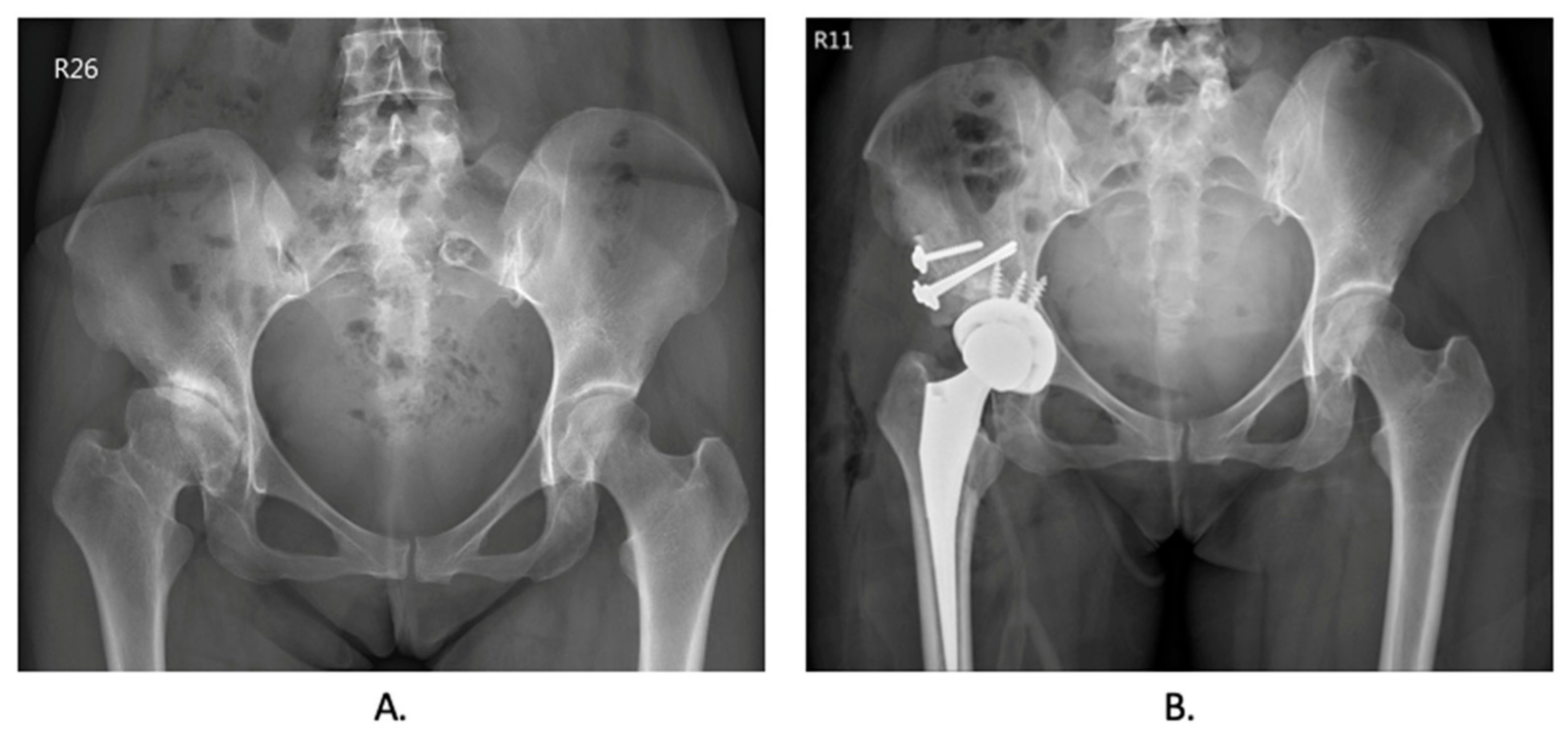 A Novel Technique for Autograft Preparation Using Patient-Specific Instrumentation (PSI ...