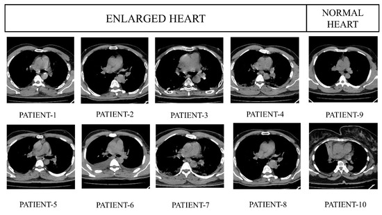 An Efficient, Lightweight, Tiny 2D-CNN Ensemble Model to Detect ...