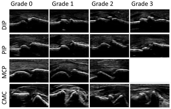 High Frequency of Osteophytes Detected by High-Resolution Ultrasound at ...