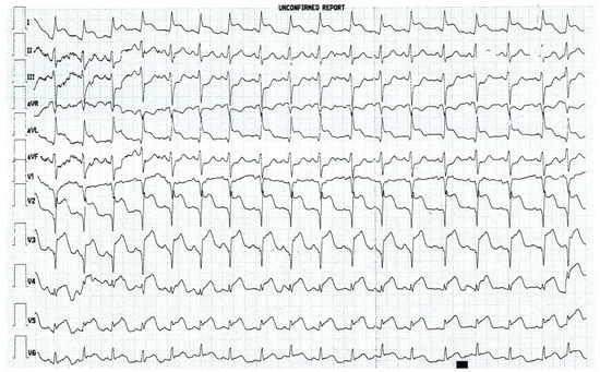 Successful Caesarean Section on Ticagrelor Treatment One Day after ...