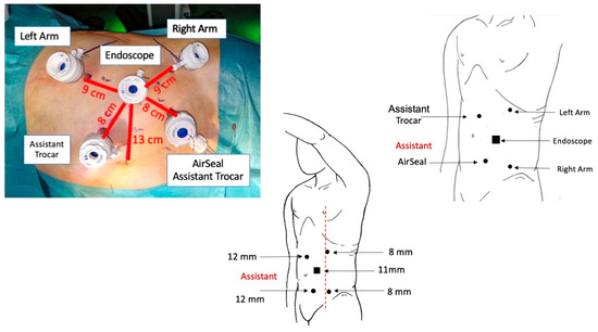Robot-Assisted Renal Surgery with the New Hugo Ras System: Trocar ...