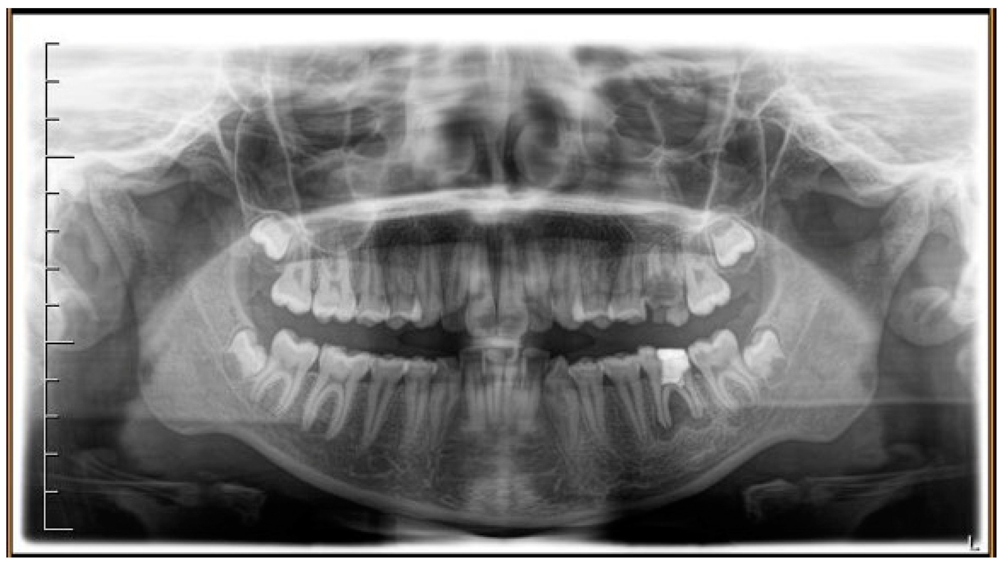 The Power of Customized Clear Aligners in Closing Molar Edentulous ...