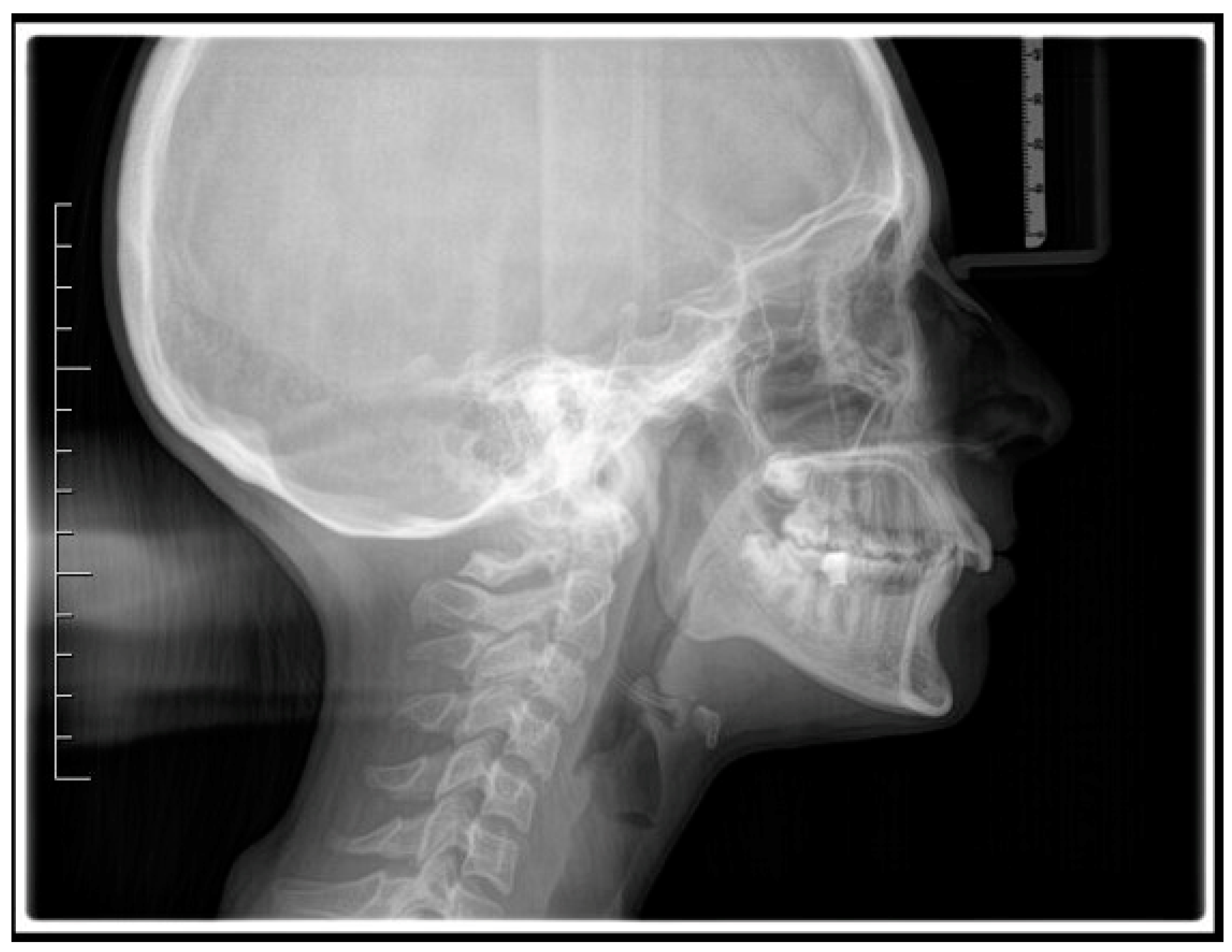 The Power of Customized Clear Aligners in Closing Molar Edentulous ...