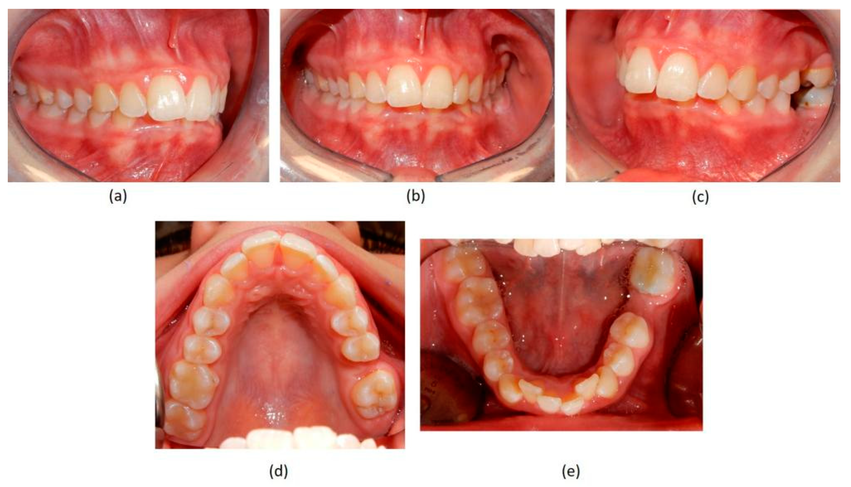 The Power of Customized Clear Aligners in Closing Molar Edentulous ...