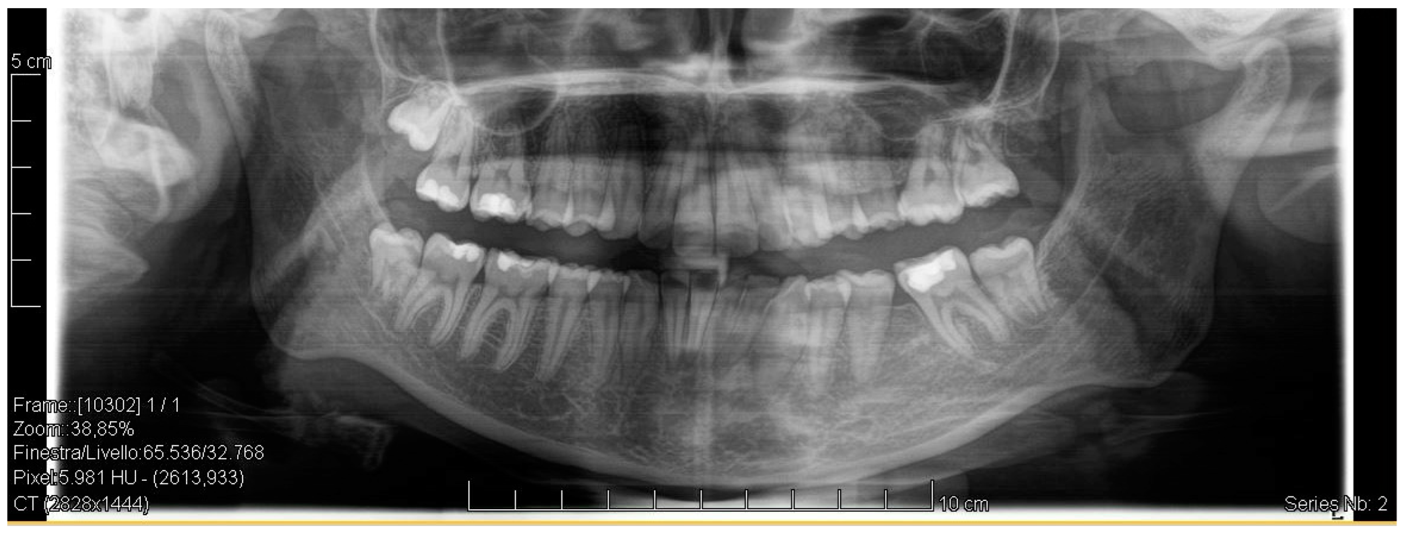 The Power of Customized Clear Aligners in Closing Molar Edentulous ...