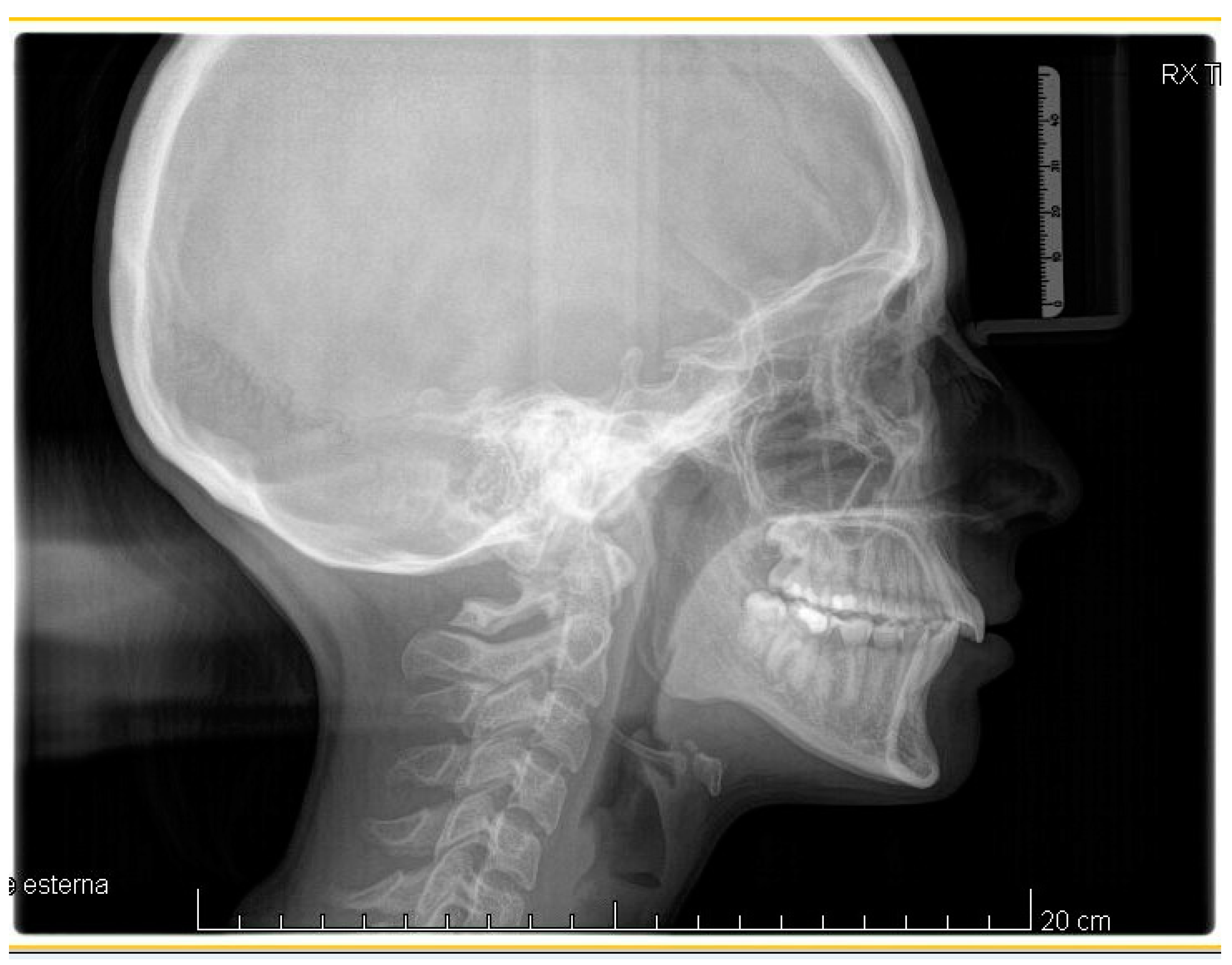 The Power of Customized Clear Aligners in Closing Molar Edentulous ...