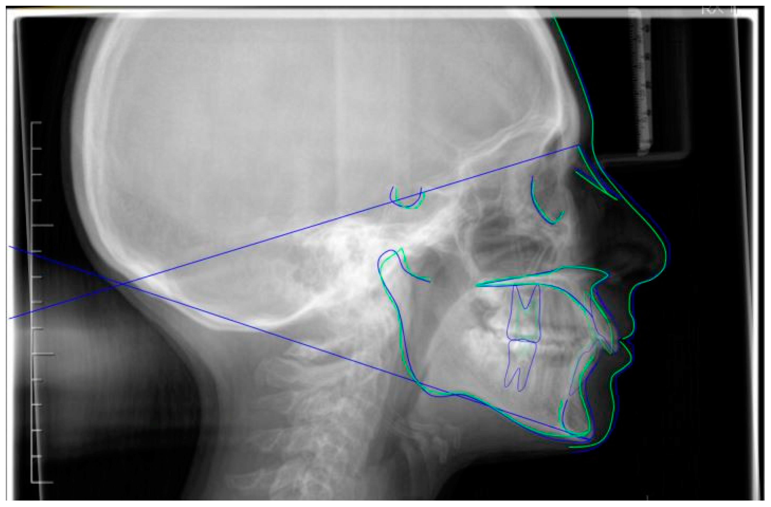 The Power of Customized Clear Aligners in Closing Molar Edentulous ...