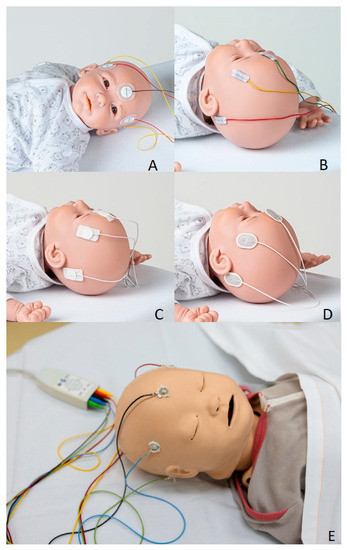 Integrating Neuromonitoring in Pediatric Emergency Medicine: Exploring ...
