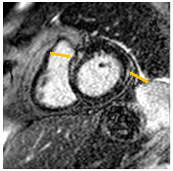 Cardiac Magnetic Resonance in Patients with Suspected Tachycardia ...