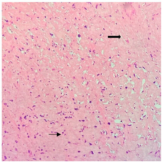 Extremely Rare Type of Breast Cancer—Dedifferentiated Breast ...