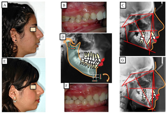 Comprehensive Deciphering the Complexity of the Deep Bite: Insight from ...