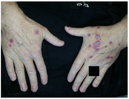 Cutaneous Manifestations of Rheumatoid Arthritis: Diagnosis and Treatment