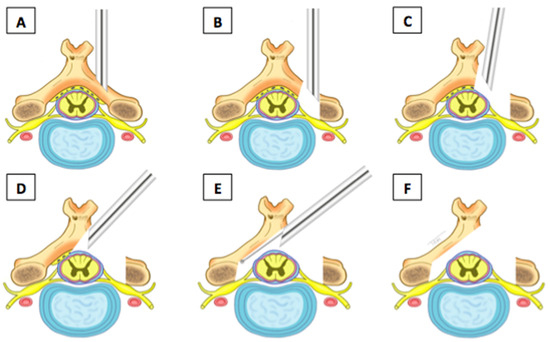 JPM | Free Full-Text | Surgical Technique of Central and Over-the-Top ...