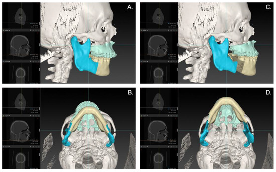 Assessment of Surgical Accuracy in Maxillomandibular Advancement ...