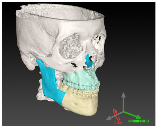 Assessment of Surgical Accuracy in Maxillomandibular Advancement ...
