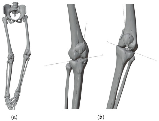JPM | Free Full-Text | Side-to-Side Flipping Wedge Osteotomy: Virtual ...