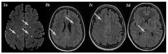 Cerebral Venous Thrombosis during Thyrotoxicosis: Case Report and ...