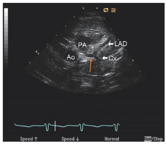 Anomalous Left Coronary Artery from the Pulmonary Artery: How to ...