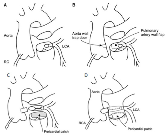 Anomalous Left Coronary Artery from the Pulmonary Artery: How to ...