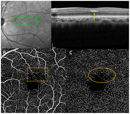 Retinal Findings and Cardiovascular Risk: Prognostic Conditions, Novel ...