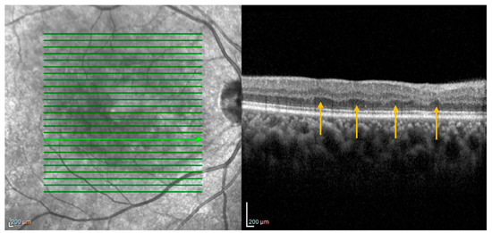 Retinal Findings and Cardiovascular Risk: Prognostic Conditions, Novel ...
