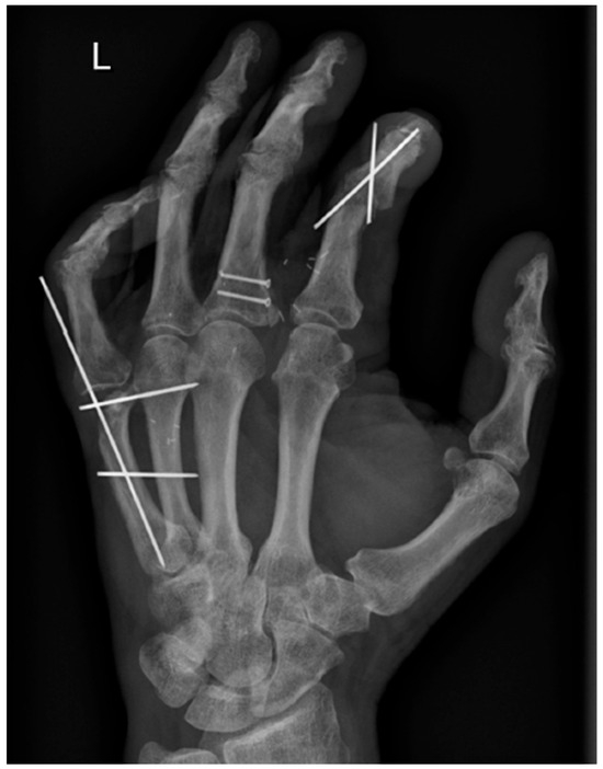 Metacarpophalangeal Joint Reconstruction of a Complex Hand Injury with ...