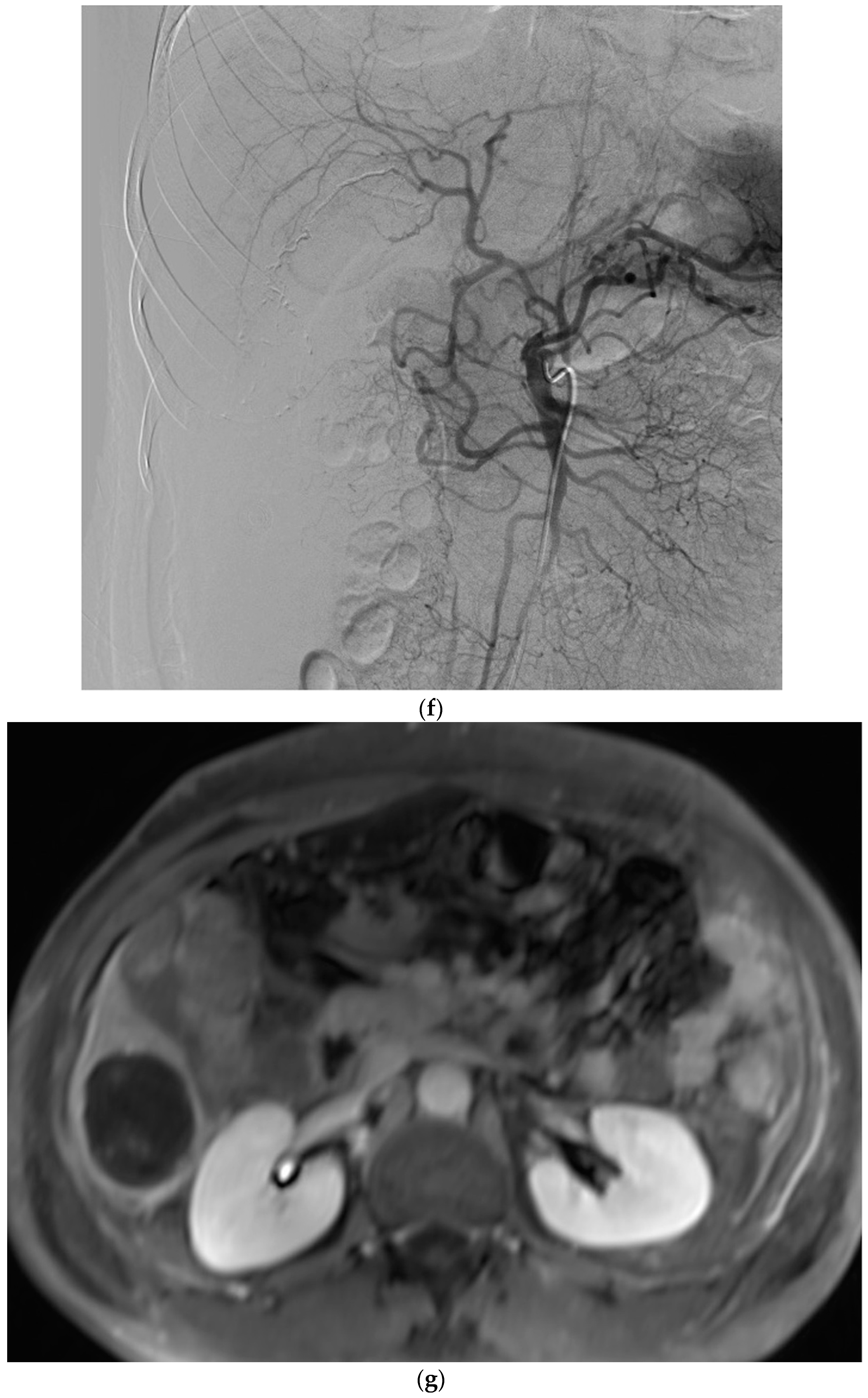 Jpm Free Full Text Selective Arterial Embolization Of Ruptured