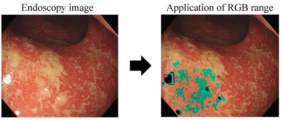 Using a Deep Learning Model to Address Interobserver Variability in the Evaluation of Ulcerative ...