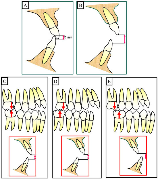 JPM | Free Full-Text | Anterior Open Bite Malocclusion: From Clinical ...