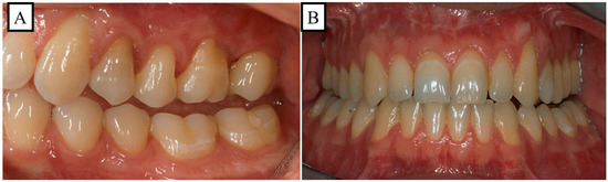 Anterior Open Bite Malocclusion: From Clinical Treatment Strategies ...