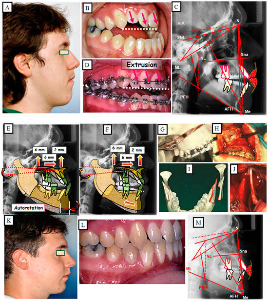 Anterior Open Bite Malocclusion: From Clinical Treatment Strategies ...