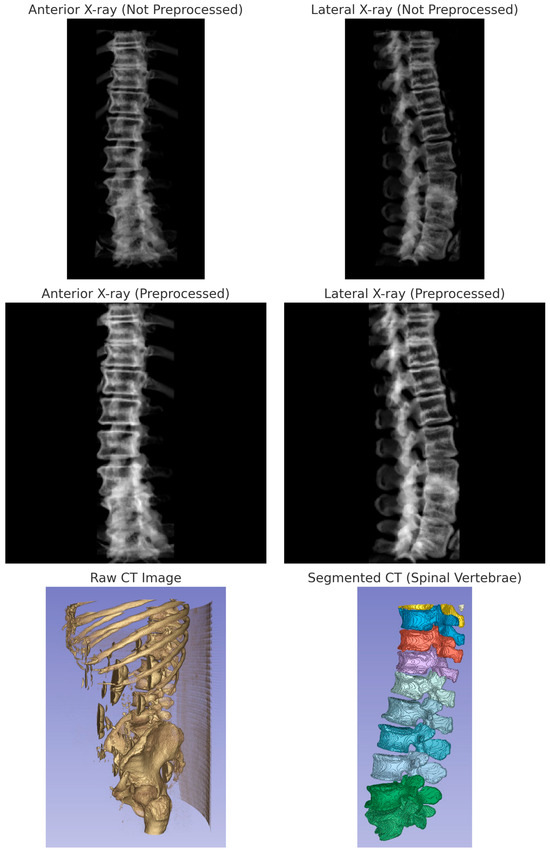 Synthetic 3D Spinal Vertebrae Reconstruction from Biplanar X-rays ...