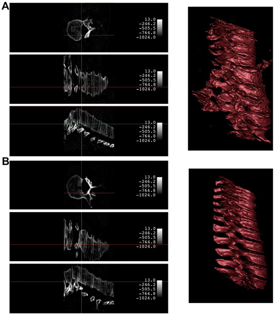 Synthetic 3D Spinal Vertebrae Reconstruction from Biplanar X-rays Utilizing Generative ...