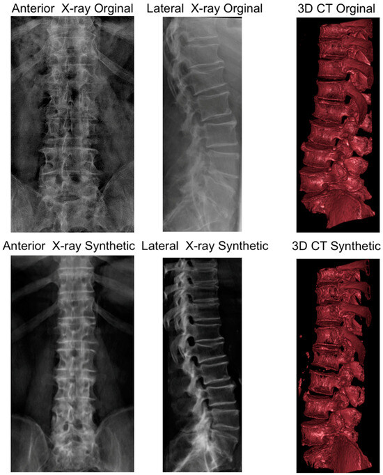 Synthetic 3D Spinal Vertebrae Reconstruction from Biplanar X-rays ...