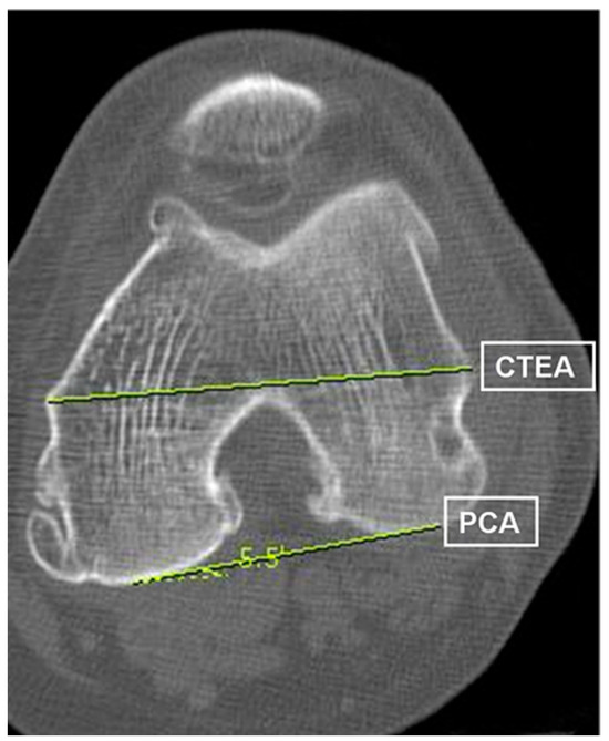 JPM | Free Full-Text | “Boot Sign” of Anterior Femoral Condylar ...