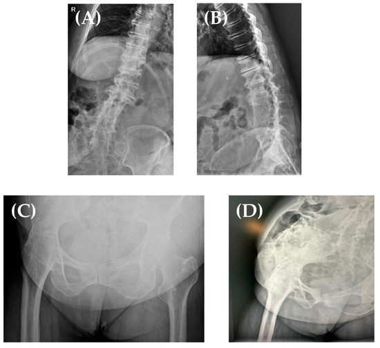 Total Knee Arthroplasty in Patients with Ipsilateral Hip Fusion ...