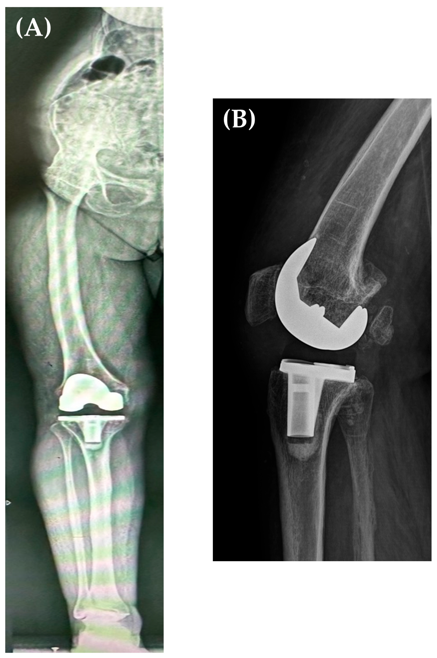 Jpm Free Full Text Total Knee Arthroplasty In Patients With