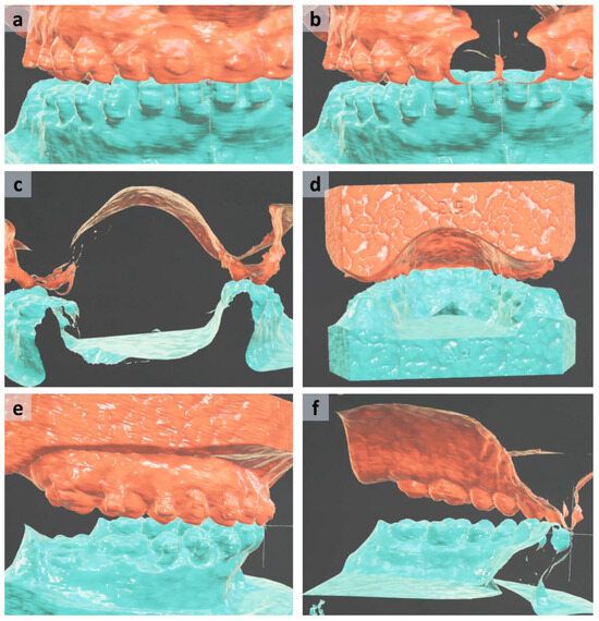 A New Approach to Virtual Occlusion in Orthognathic Surgery Planning ...