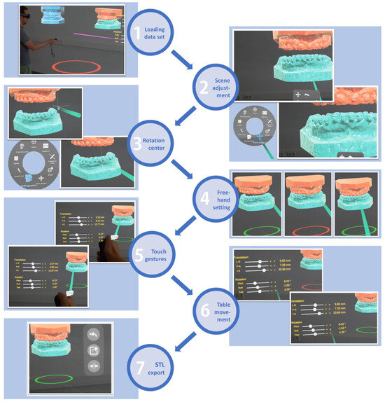 A New Approach to Virtual Occlusion in Orthognathic Surgery Planning ...
