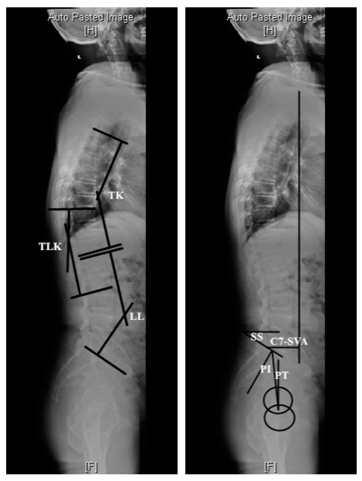 JPM | Free Full-Text | Thoracolumbar/Lumbar Degenerative Kyphosis—The Importance of ...