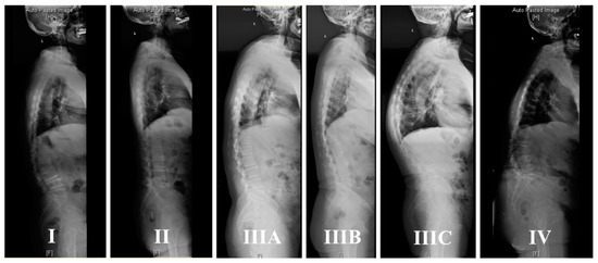 Thoracolumbar/Lumbar Degenerative Kyphosis—The Importance of ...