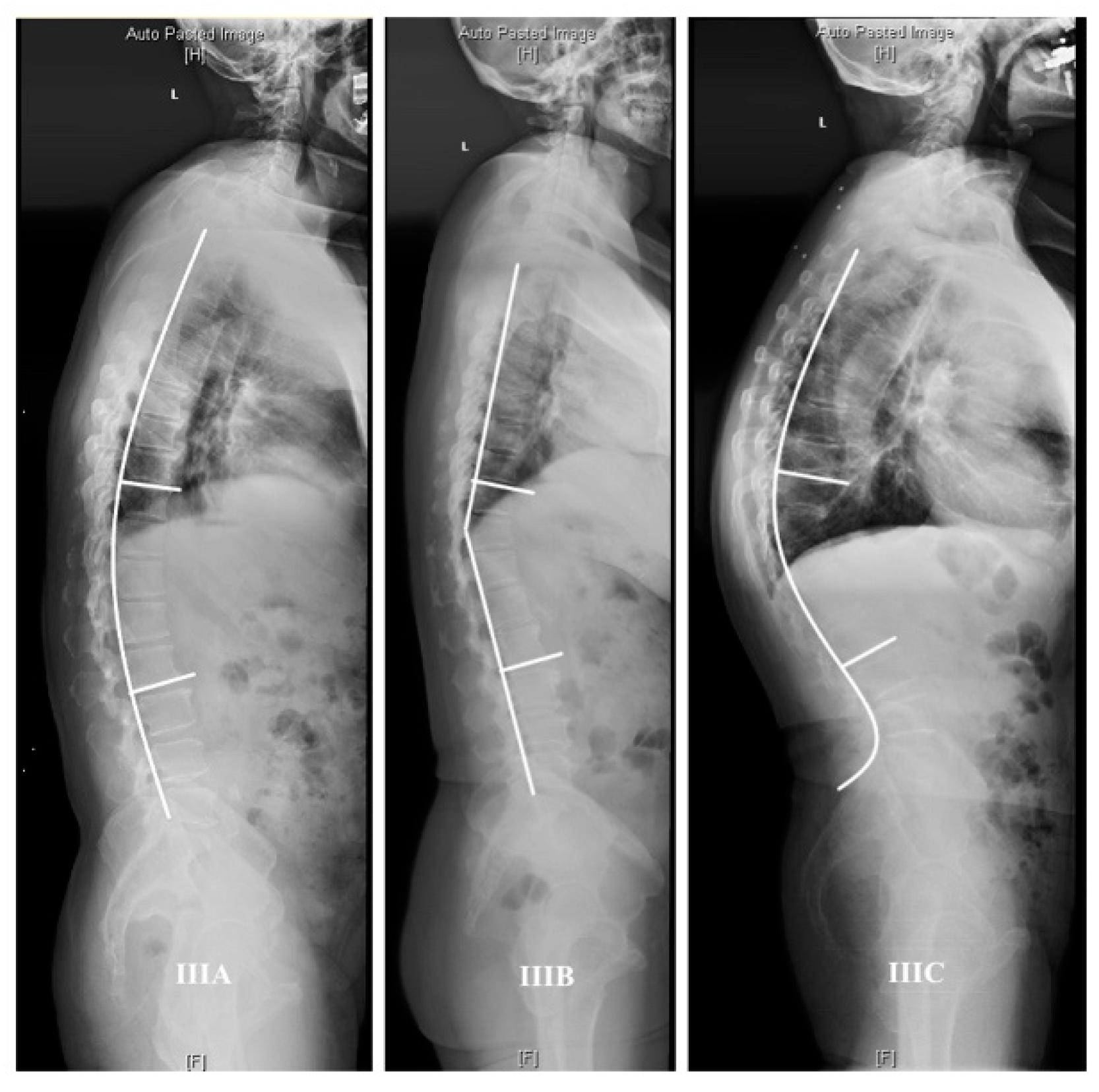 JPM | Free Full-Text | Thoracolumbar/Lumbar Degenerative Kyphosis—The Importance of ...
