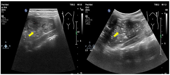 Clinical and Molecular Characterization of a Patient with Generalized ...