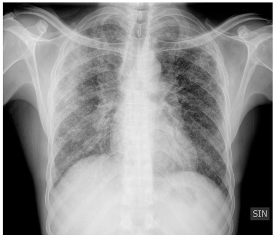 Noninfectious Granulomatous Lung Disease: Radiological Findings and ...