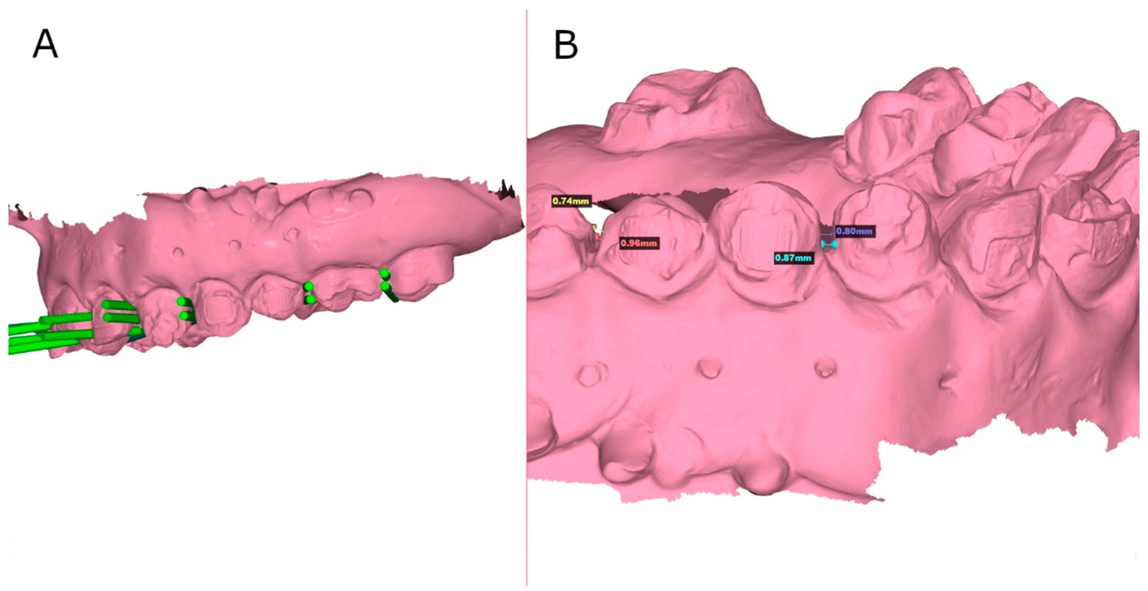 Novel Technique of Interproximal Enamel Reduction Based on Computer ...