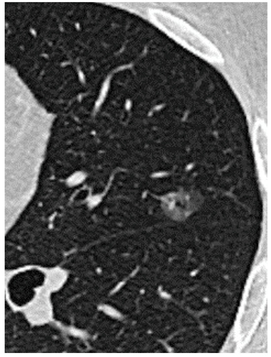 JPM | Free Full-Text | Prognostic Factors of Non-Predominant-Lepidic ...