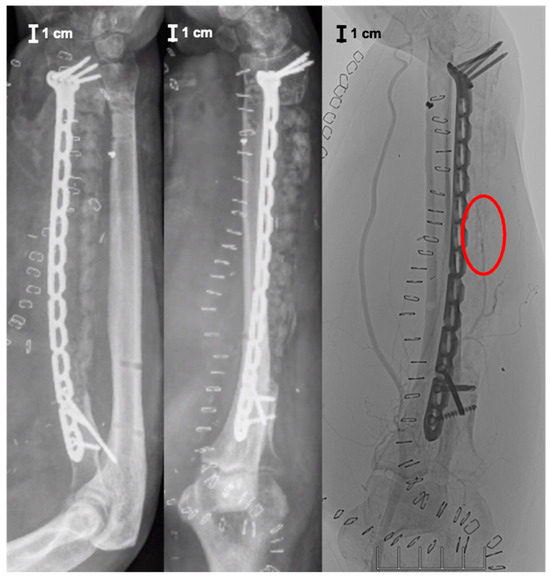 Reconstruction of an Extensive Segmental Radial Shaft Bone Defect by ...