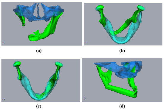 A Novel Method for Secondary Mandible Reconstruction to Re-Achieve a ...