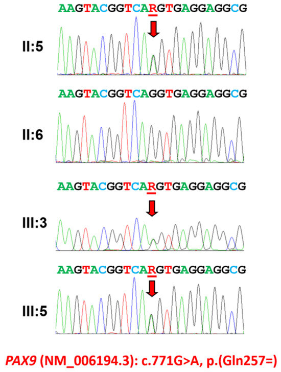 Novel PAX9 Mutations Causing Isolated Oligodontia